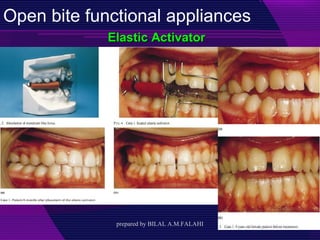 Myofunctional appliances in orthodontic | PPT