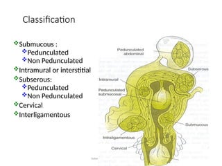 uterine fibroids at glance covering all types | PPTX