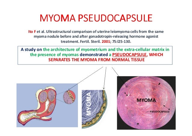 Myoma pseudocapsule, Tinelli, Barcelona 2017