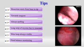 myomectomy.pptx