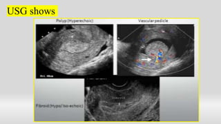 myomectomy.pptx