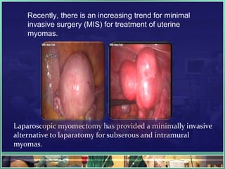Myomectomy laparoscopic-vs-laparotomy 2 | PPT