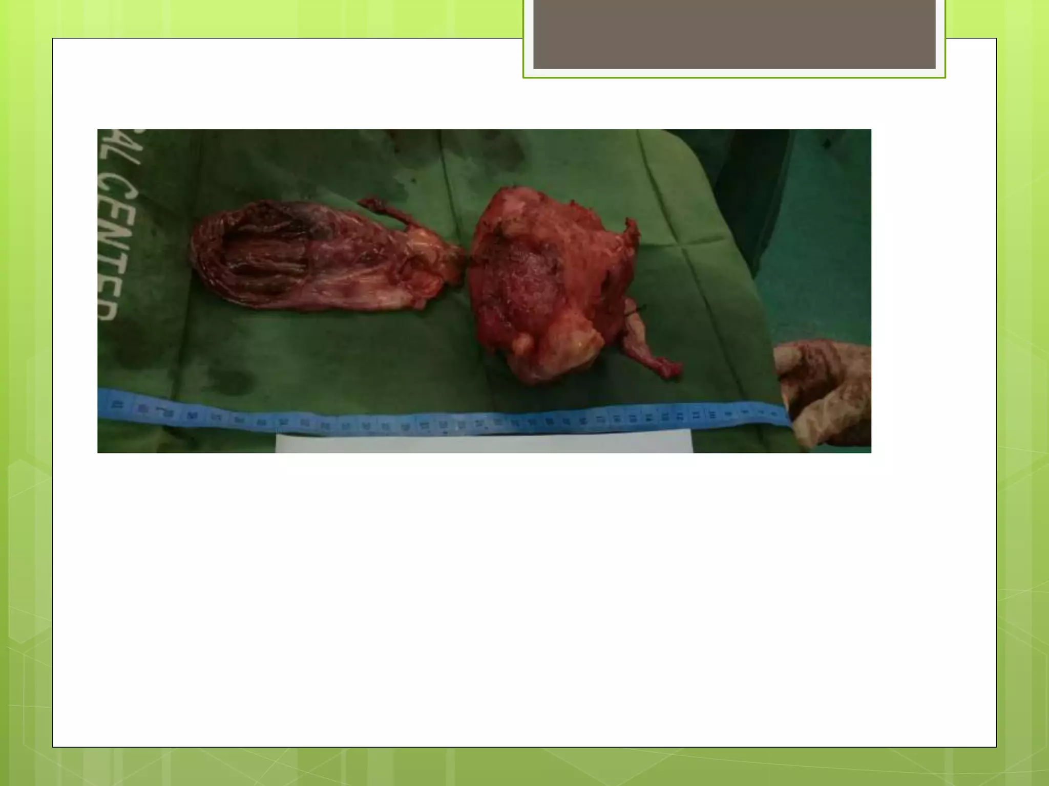 Myomectomy,adenomyosis , pelvic endometriosis case presentation | PPTX ...