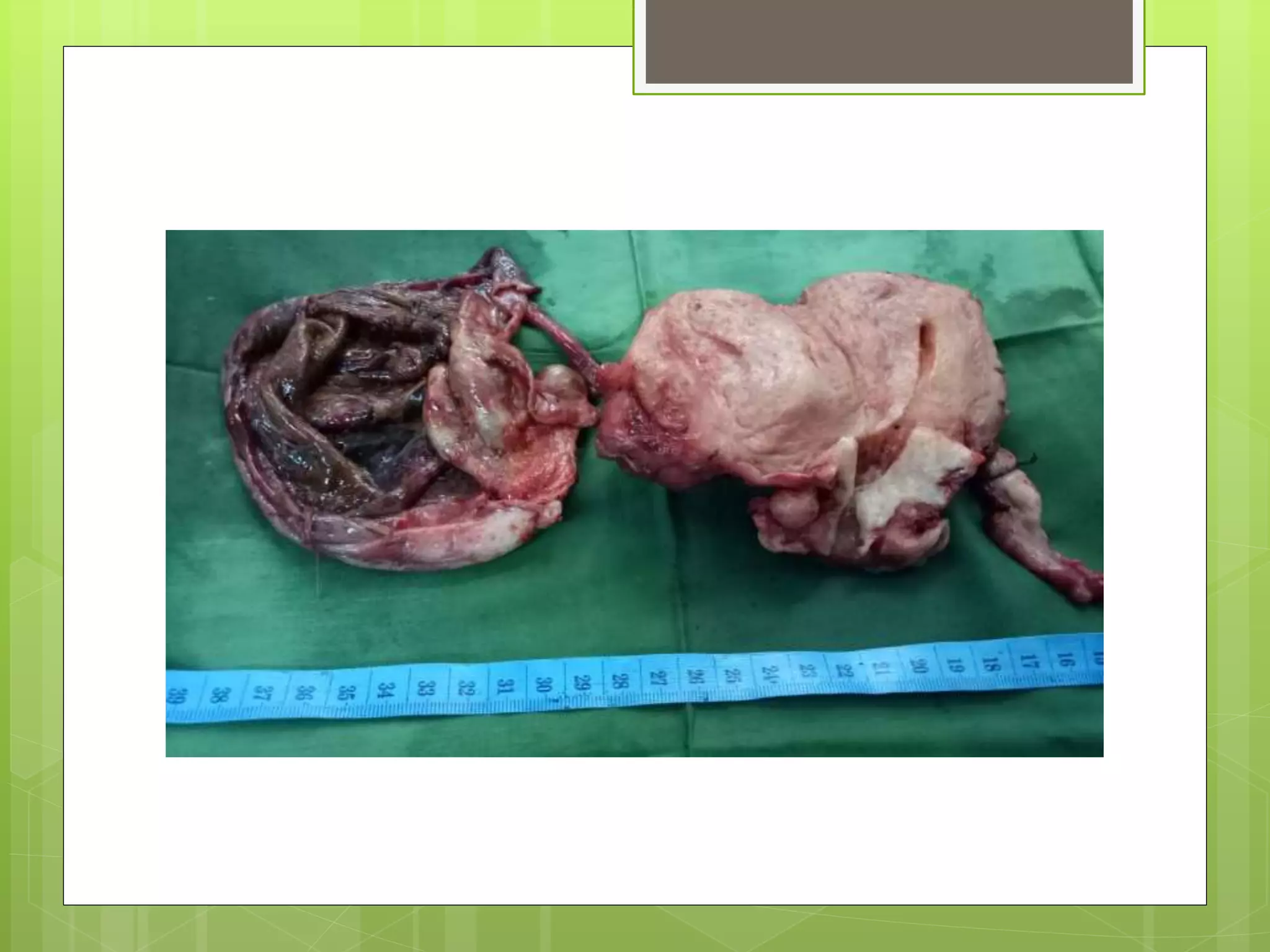 Myomectomy,adenomyosis , pelvic endometriosis case presentation | PPTX ...