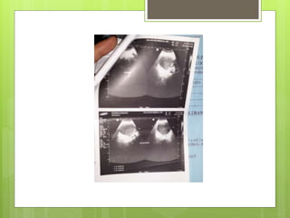 Myomectomy,adenomyosis , pelvic endometriosis case presentation | PPTX