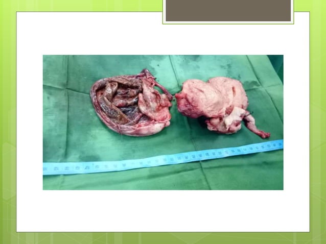 Myomectomy,adenomyosis , pelvic endometriosis case presentation | PPTX ...