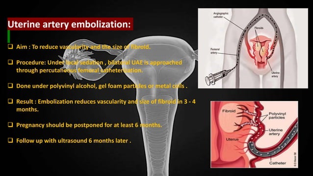 MYOMECTOMY AND OTHER CONSERVATIVE SURGERY.pptx