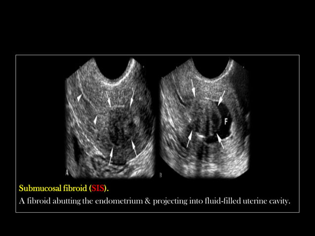 Myometrium Ultrasound, guía práctica usg | PDF | Menopause | Endocrine ...