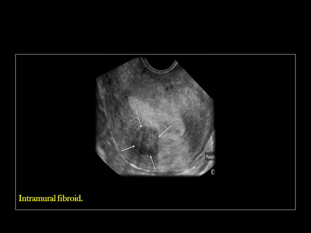 Myometrium Ultrasound, guía práctica usg | PDF | Menopause | Endocrine ...