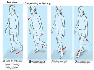 neuropathic gait and foot drop | PPTX