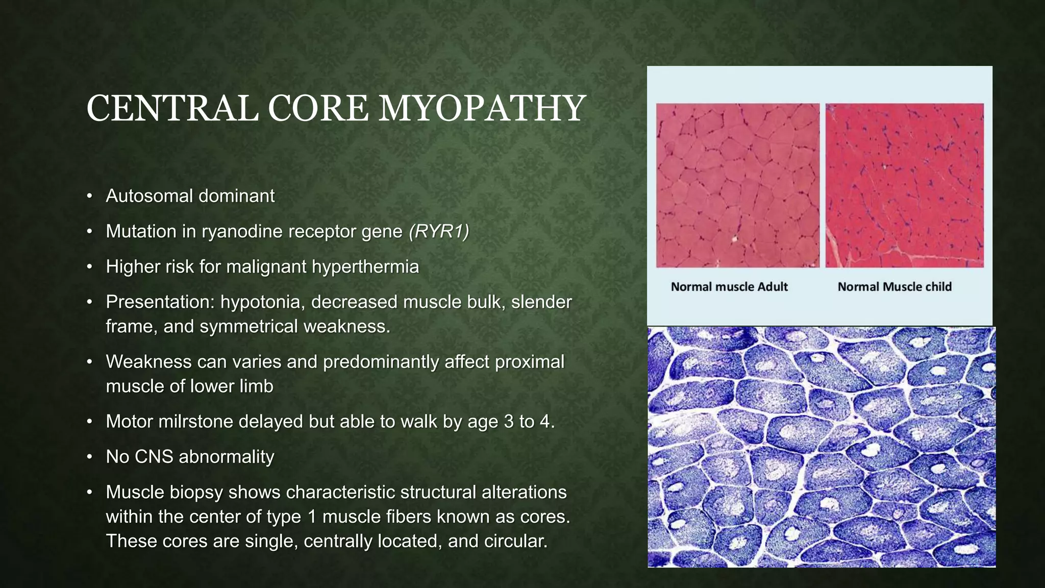 Myopathies | PPTX