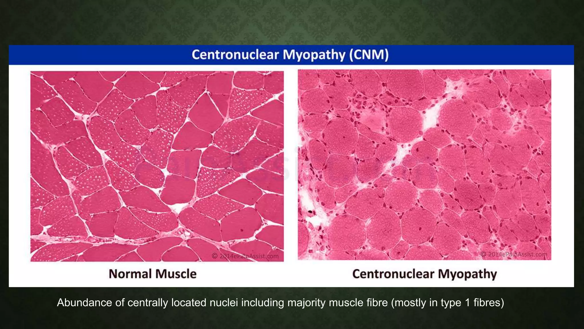 Myopathies | PPTX