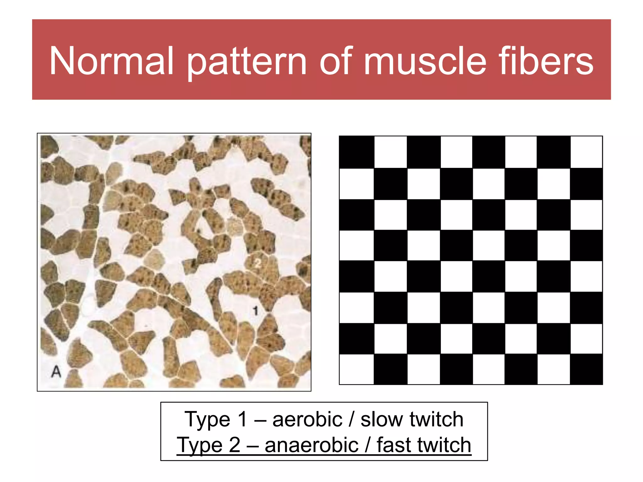Myopathies | PPTX