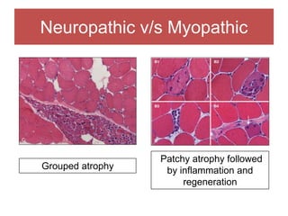 Myopathies | PPT