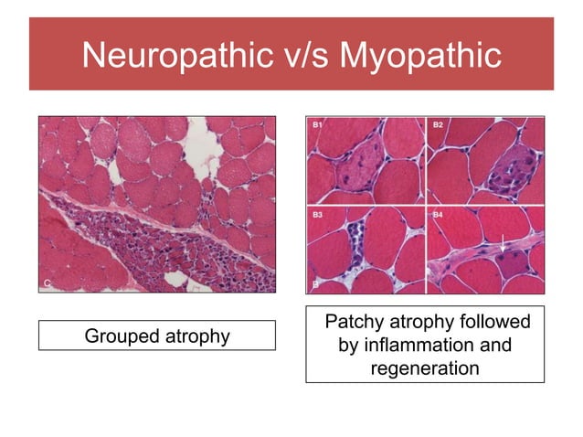 Myopathies | PPT