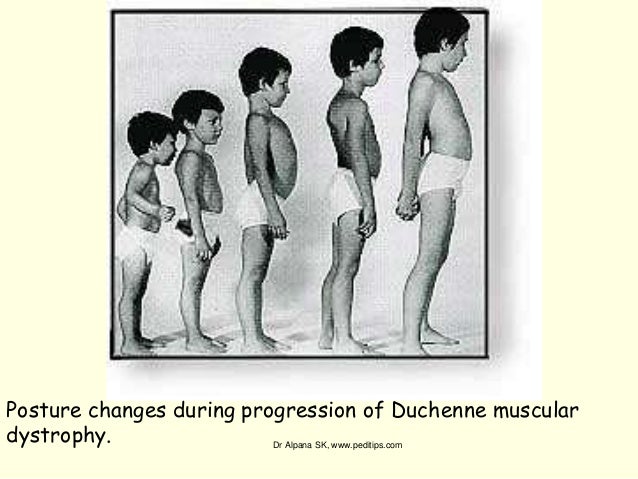 Muscular Dystrophies In Childhood
