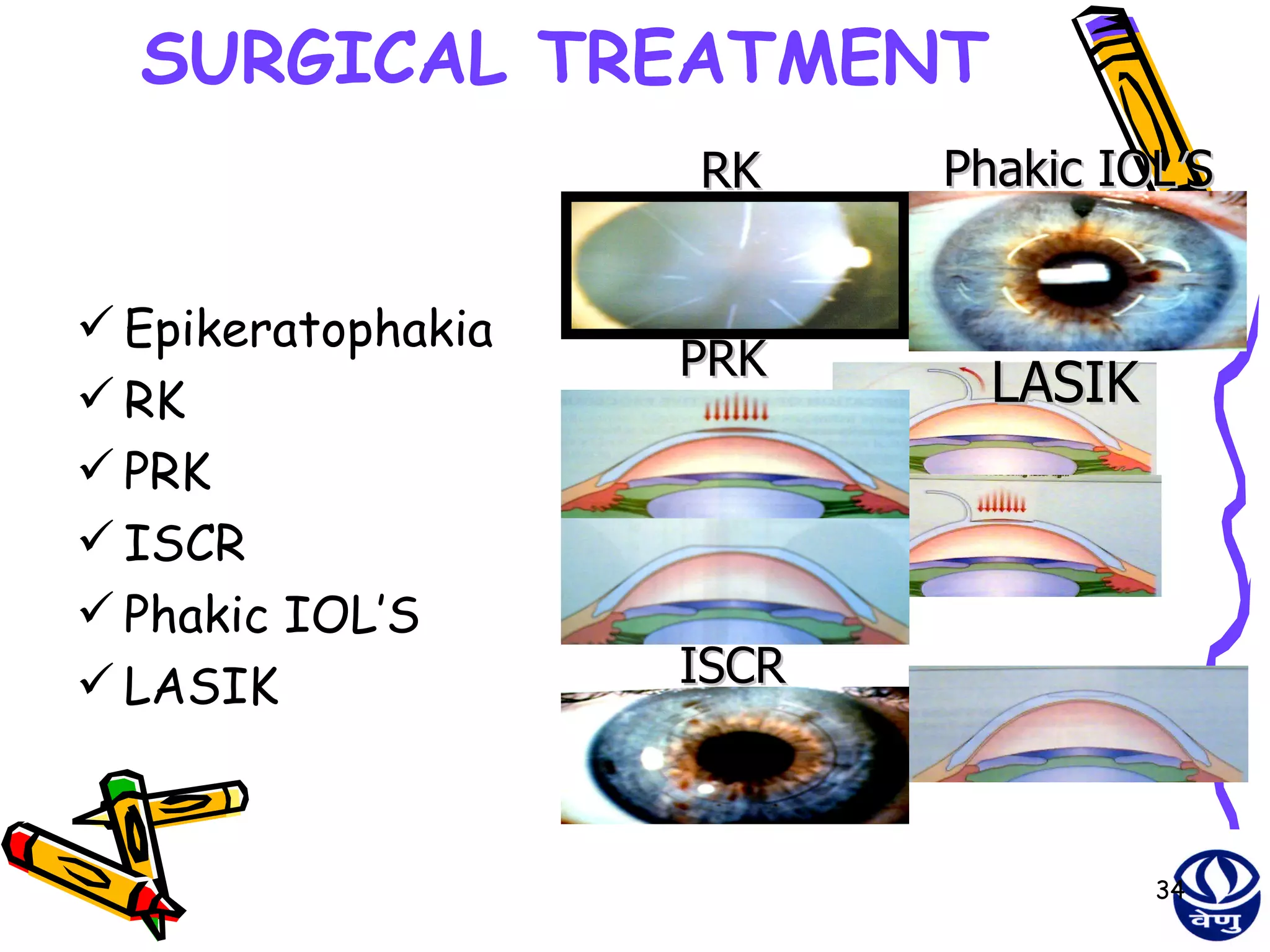 Myopia | PPT