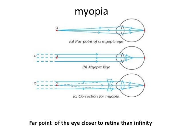 Myopia