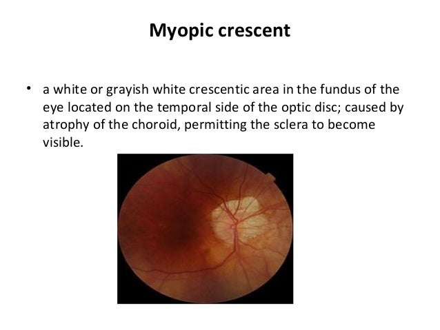 Myopia