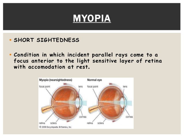 Myopia