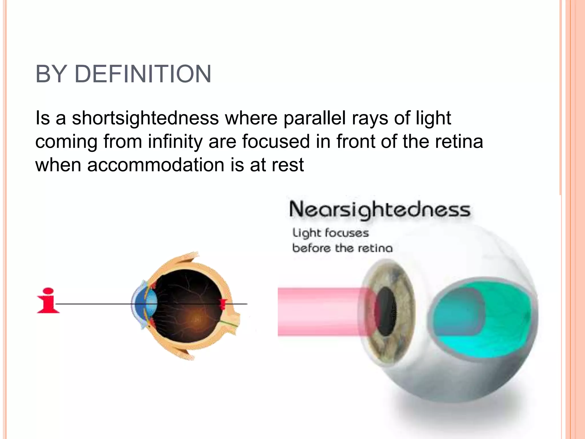 Myopia | PPTX