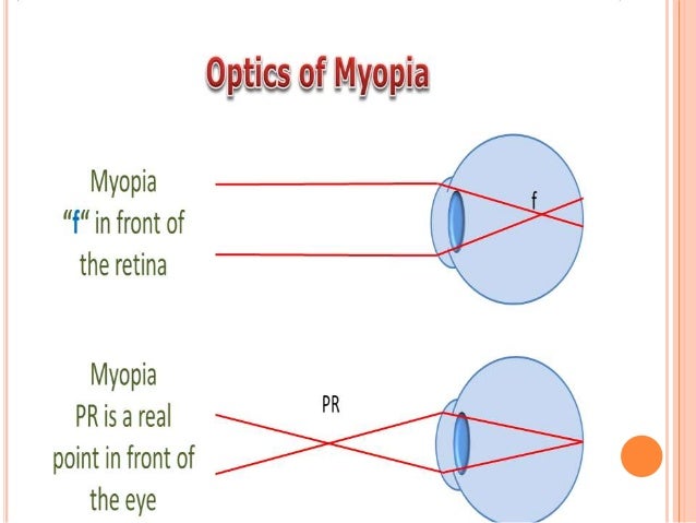 Myopia