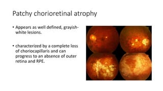 Myopia | PPTX