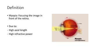 Myopia | PPTX