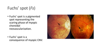 Myopia | PPT