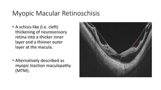 Myopia | PPTX