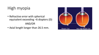 Myopia | PPTX