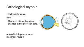 Myopia | PPT