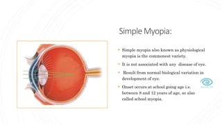 Myopia classification and management by Tahir Shaukat | PPTX