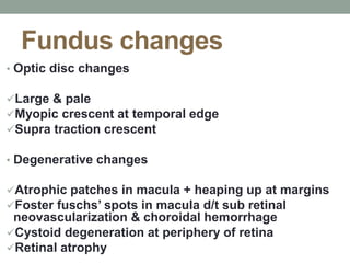 Myopia Ophthalmology ( Quick Review ) | PPT