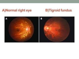 Myopia Ophthalmology ( Quick Review ) | PPT