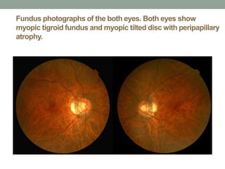 Myopia Ophthalmology ( Quick Review ) | PPT