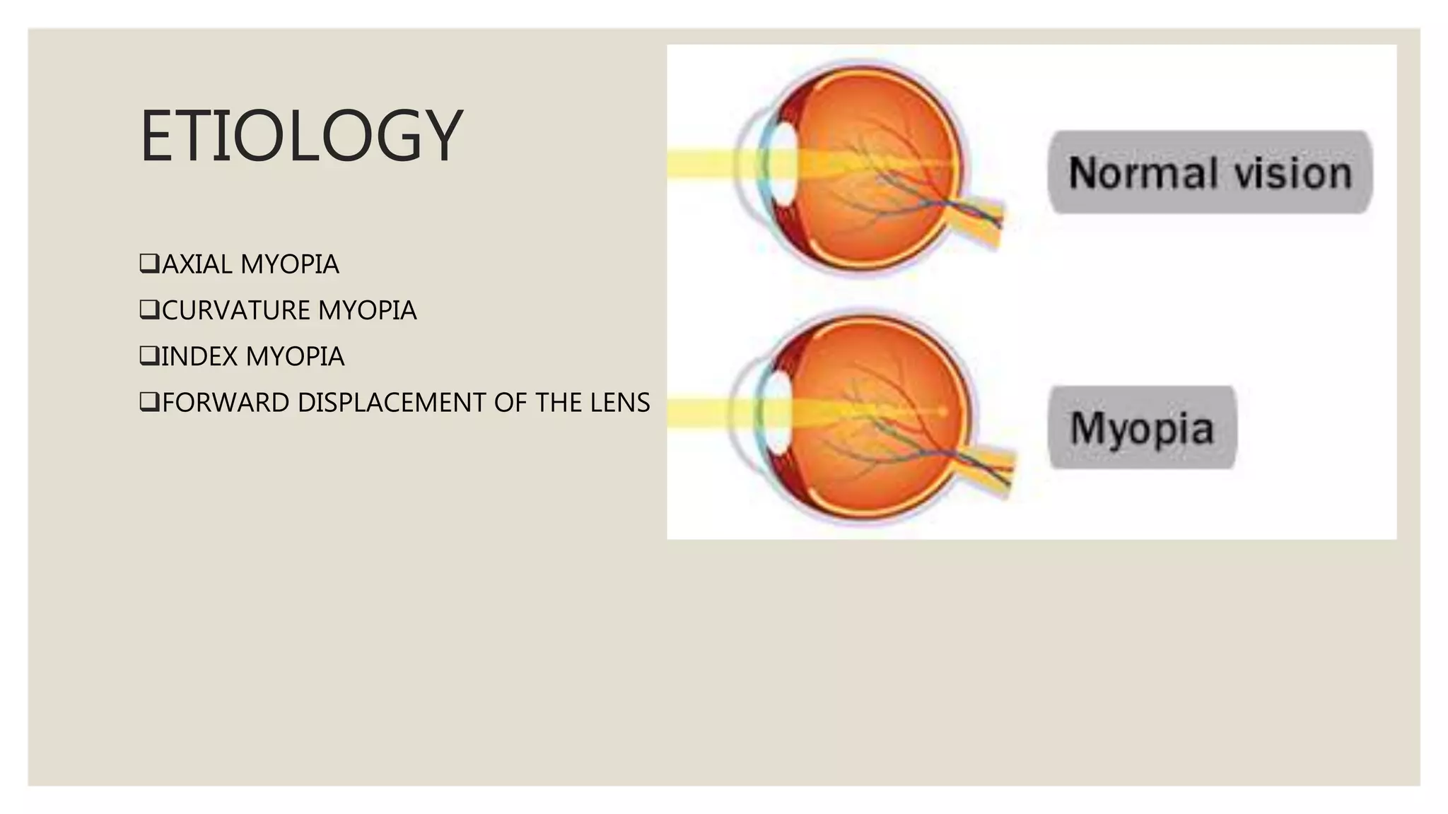 Myopia | PPT