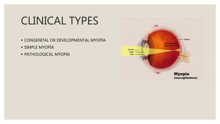 Myopia | PPT
