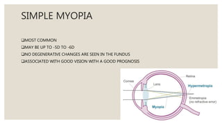 Myopia | PPT