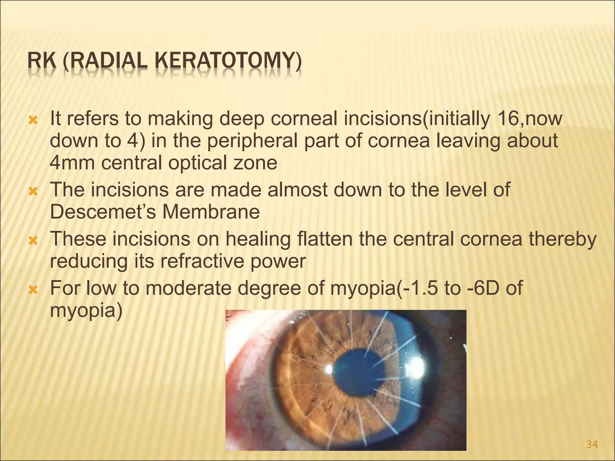 myopia.ppt