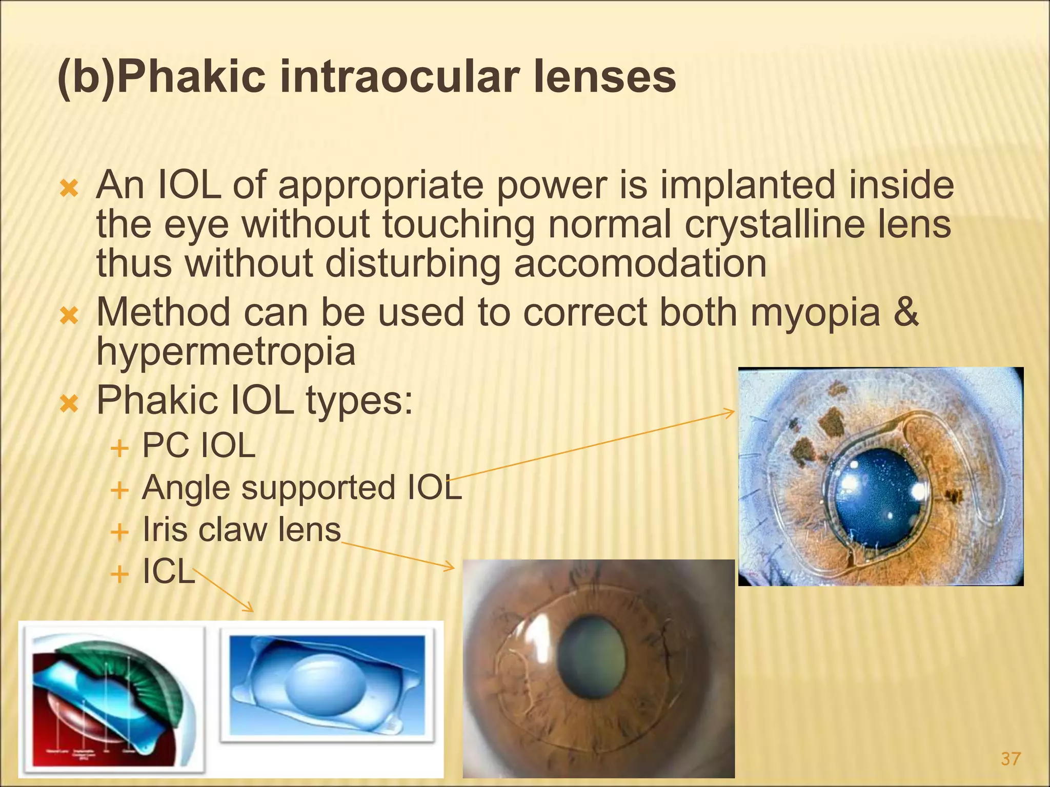 myopia.ppt