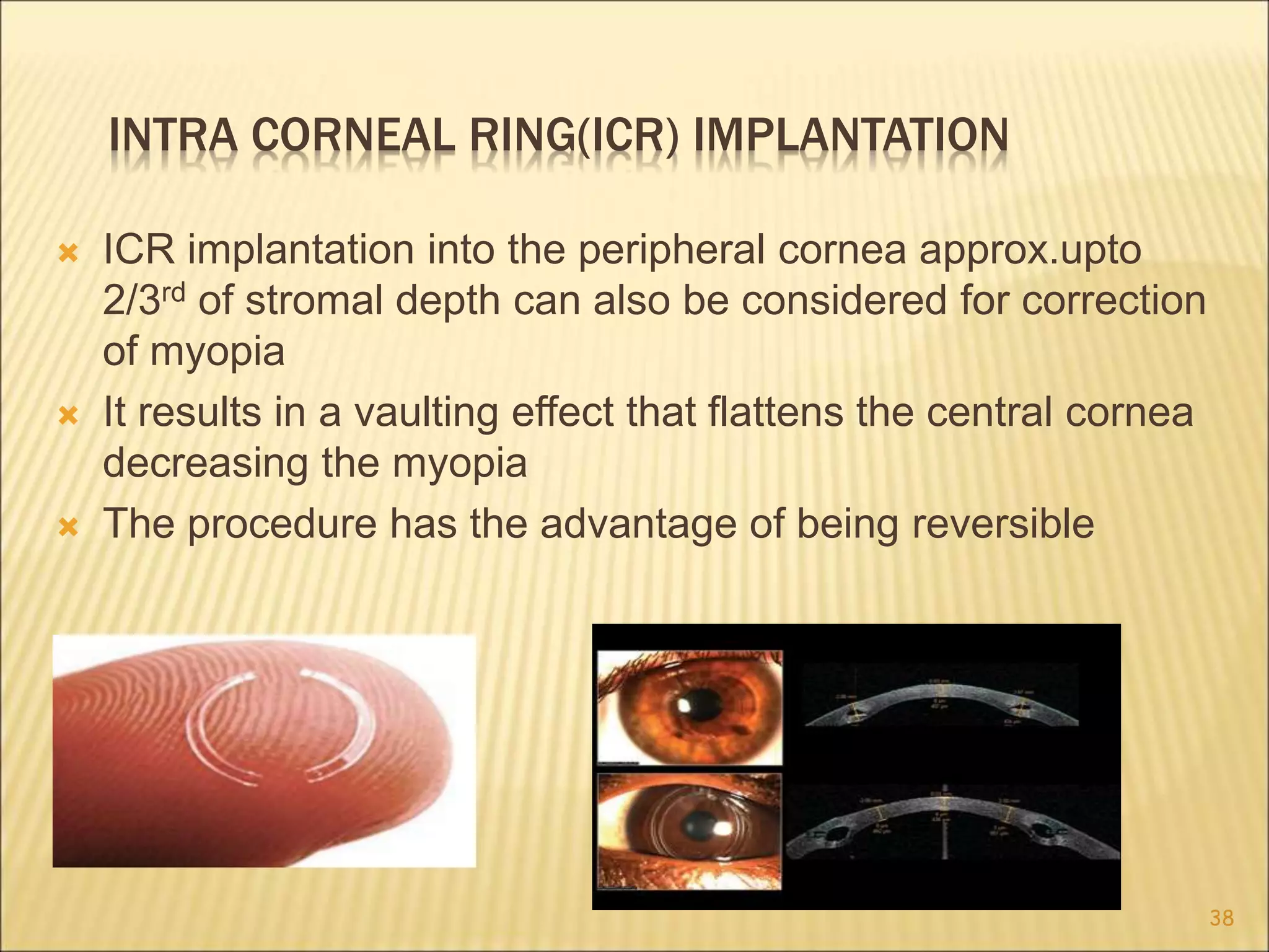 myopia.ppt