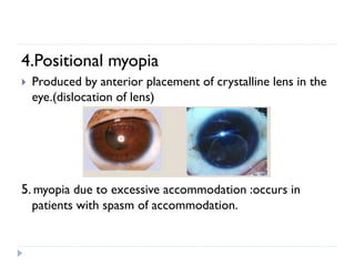 Myopia.pdf | Eye and Vision Conditions | Diseases and Conditions