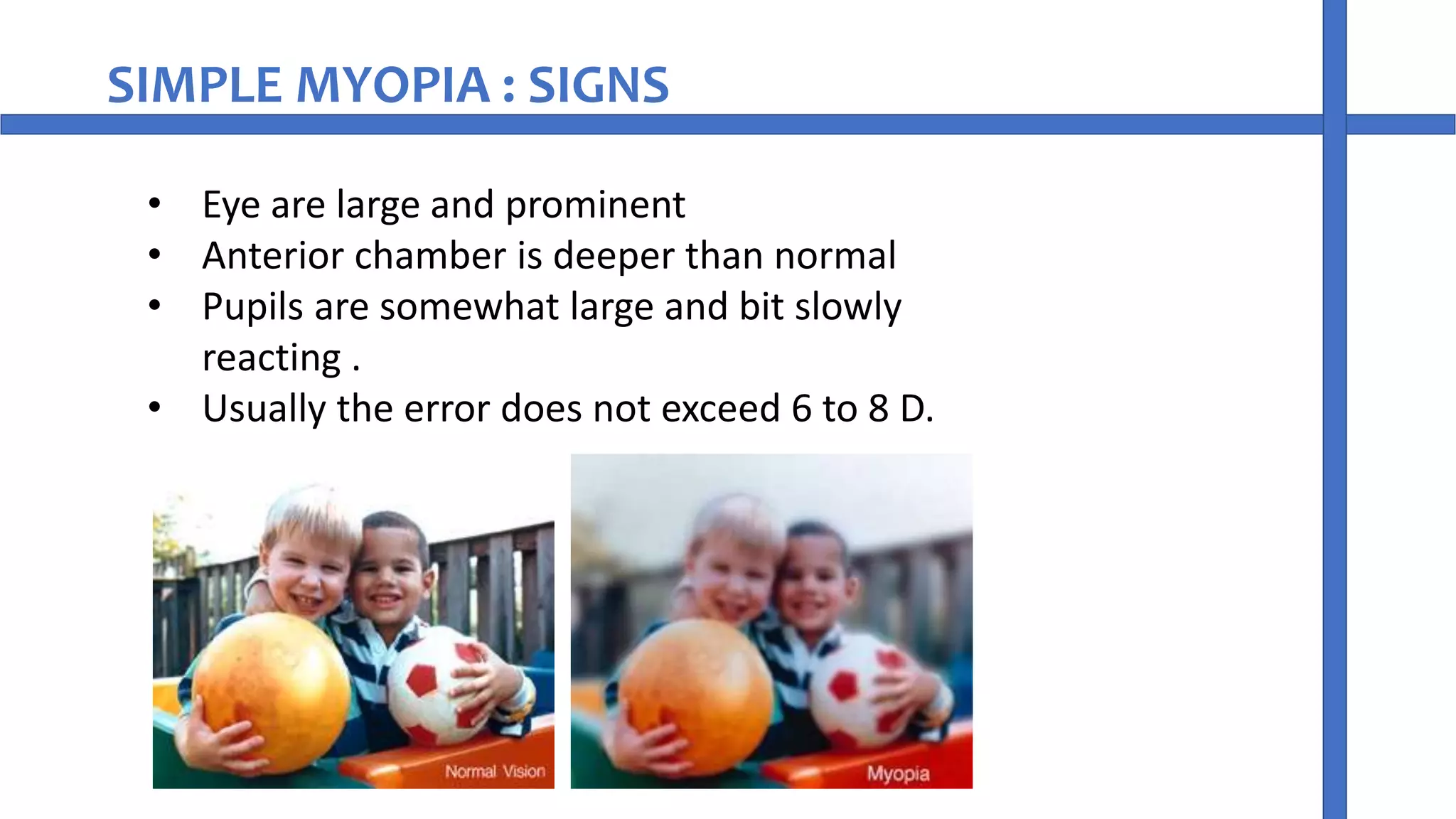 Myopia refractive error of eye | PPTX
