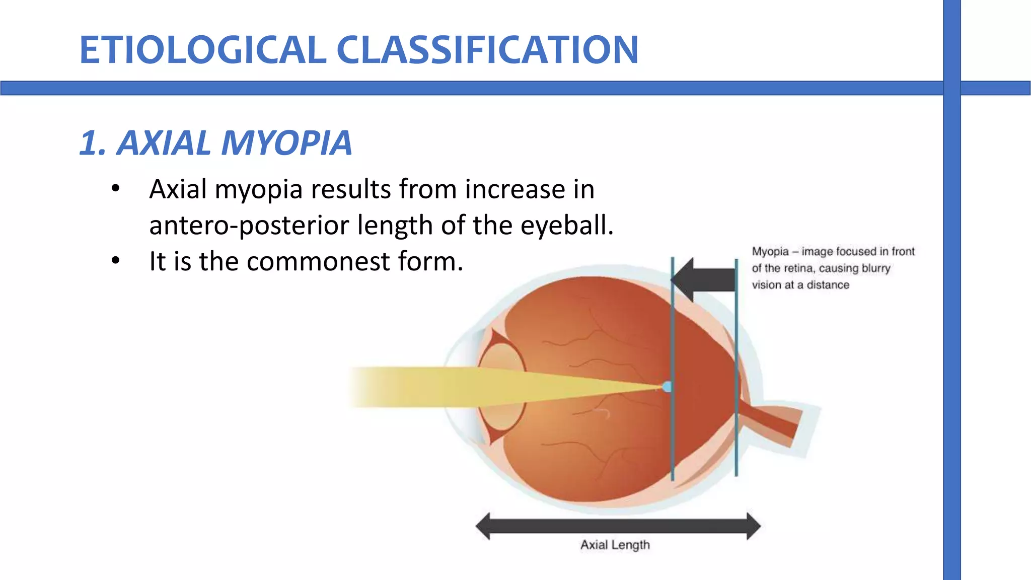 Myopia refractive error of eye | PPTX