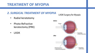 Myopia refractive error of eye | PPTX