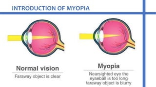 Myopia refractive error of eye | PPTX
