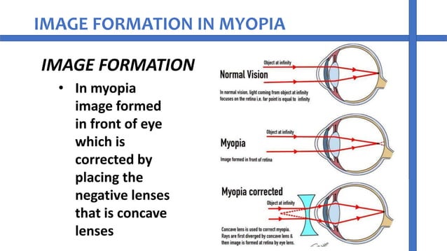Myopia refractive error of eye | PPTX