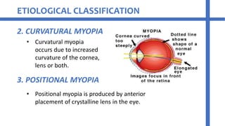Myopia refractive error of eye | PPTX