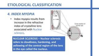 Myopia refractive error of eye | PPTX